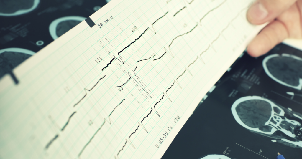 Children Born With Heart Defects at Increased Risk for Epilepsy - News ...