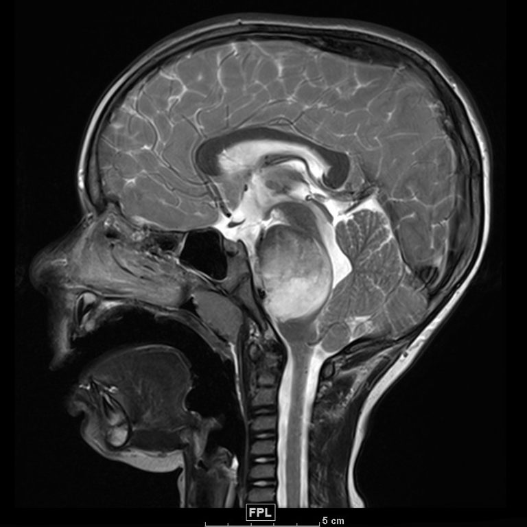Mutations Synergize in Pediatric Brain Cancer - News Center