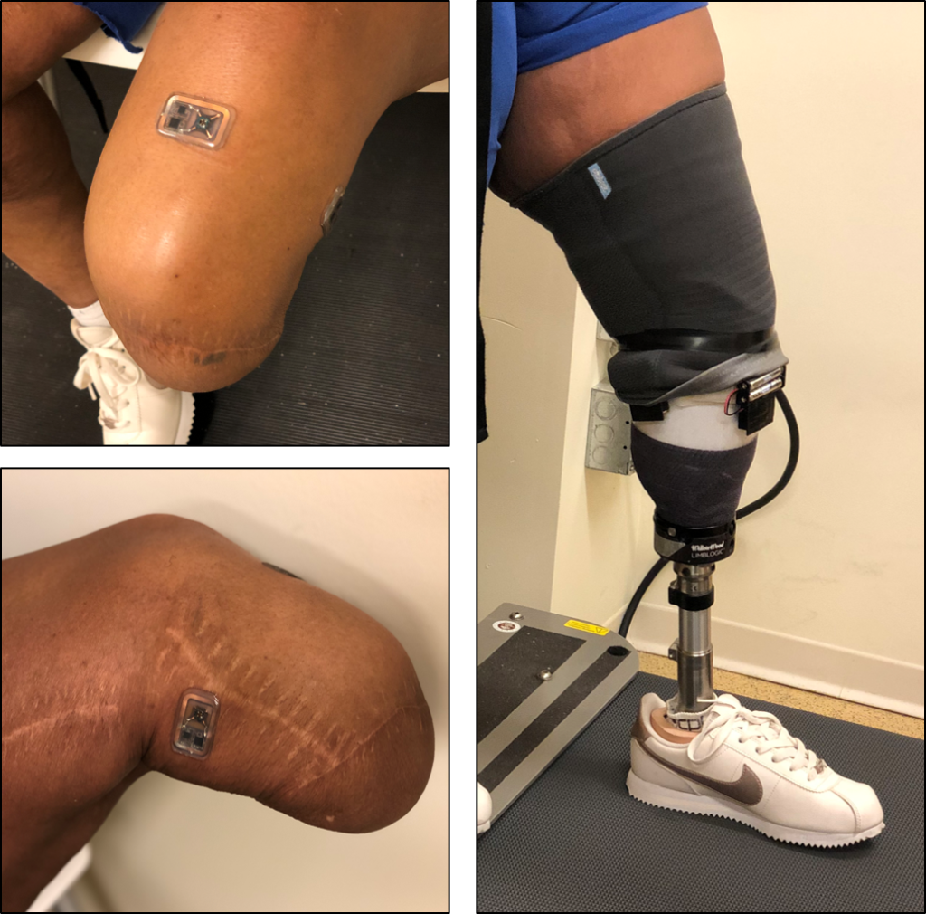 Novel Device Provides Continuous Monitoring of Skin, Prostheses - News ...