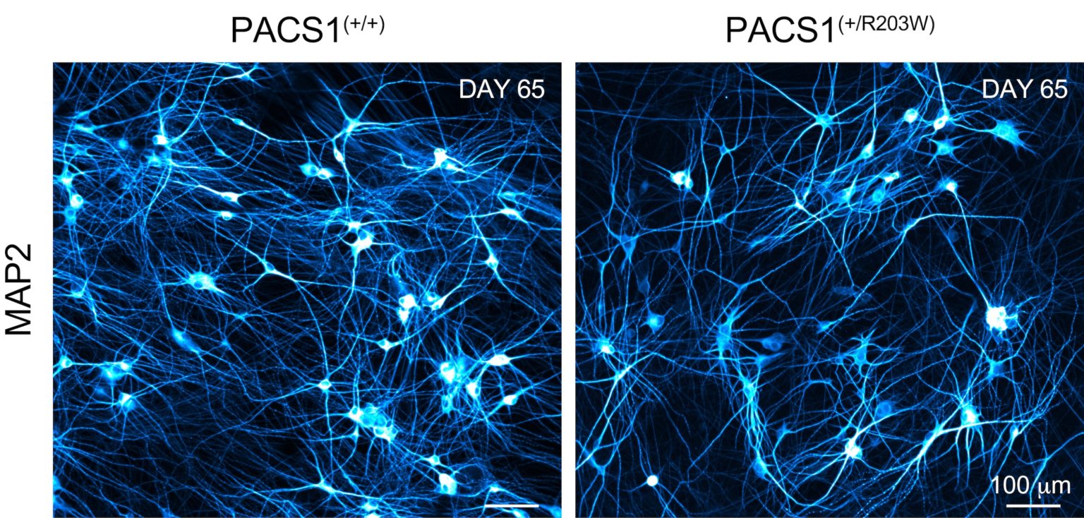 Study Identifies Molecular Mechanisms of Rare Neurodevelopmental ...