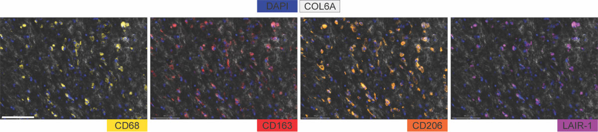 Novel Immune Inhibitor Associated with Glioma Progression - News Center