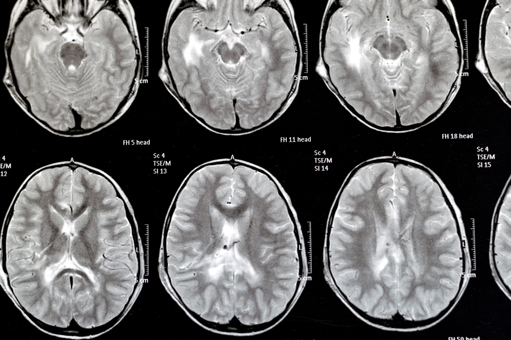 New Glioblastoma Treatment Reaches Human Brain Tumor and Helps Immune ...